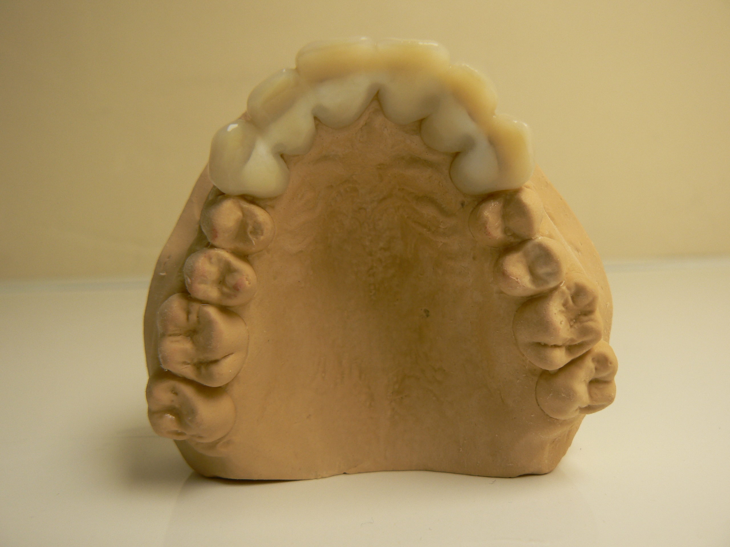 Provisoire type bridge – PN Prothèse