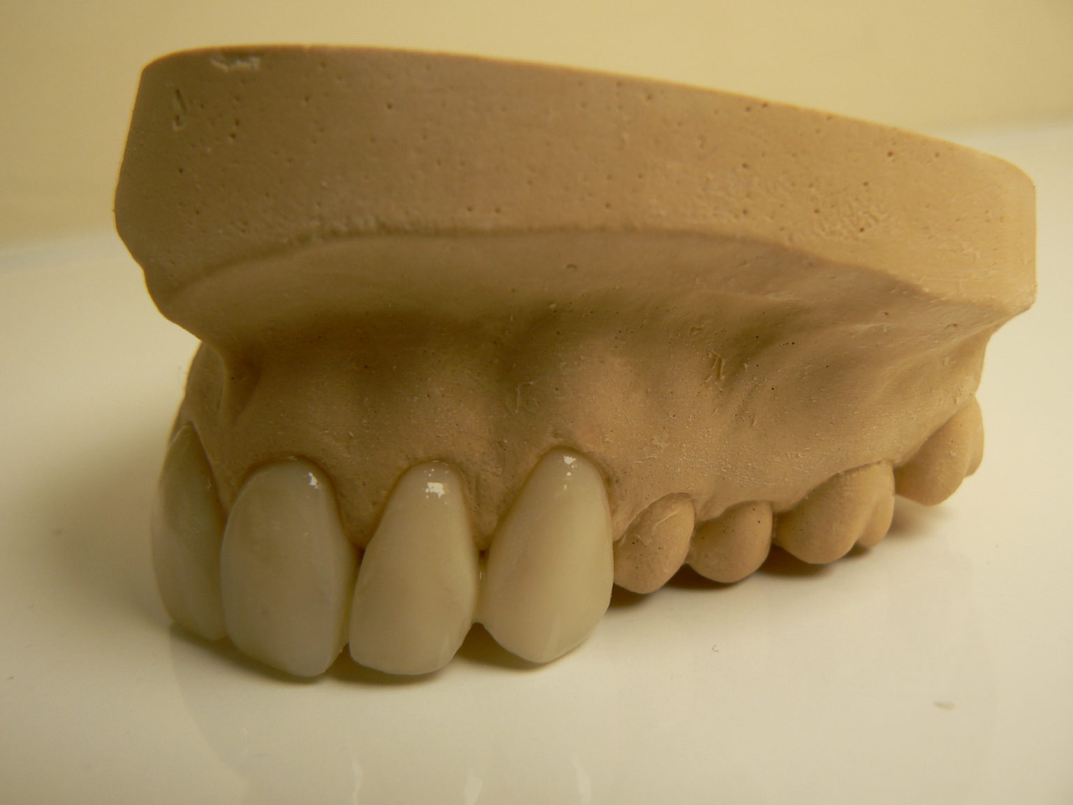 Provisoire type bridge – PN Prothèse