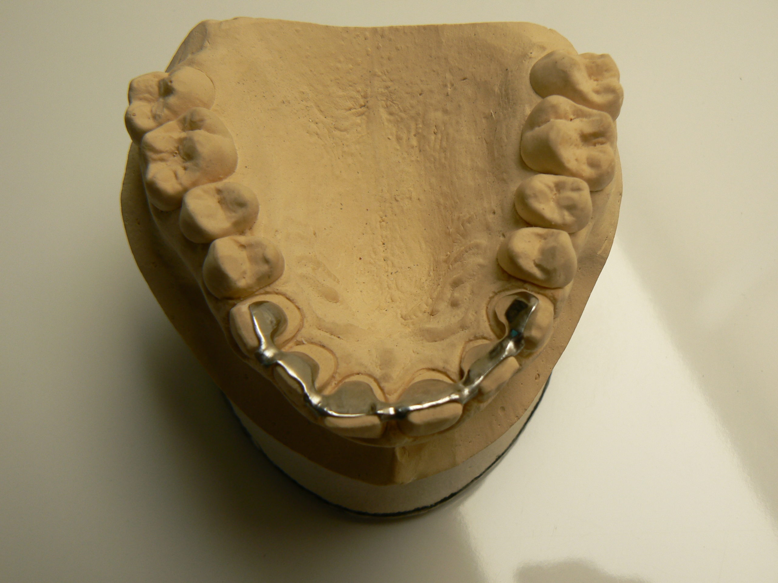 Provisoire type bridge – PN Prothèse